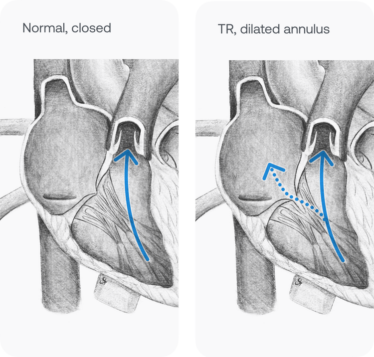 Eko Health | What Is Tricuspid Regurgitation